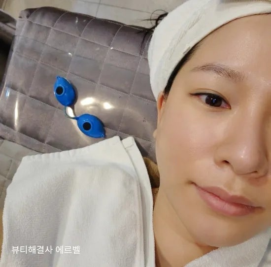은평구 연신내 포토나 레이저 토닝 받은 이유 얼굴 잡티 제거 4회차 네이버 블로그