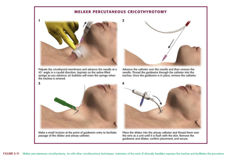 Cricothyroidotomy (윤상갑상절개술) Part Ⅱ : 네이버 블로그