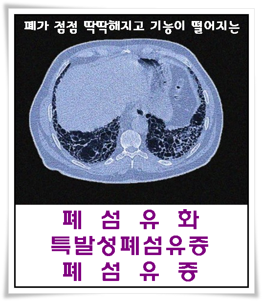 폐가 점점 딱딱해지고 기능이 떨어지는 특발성폐섬유증 폐섬유증 폐섬유화 폐섬유종과 폐섬유화증상 폐섬유화치료 네이버 블로그