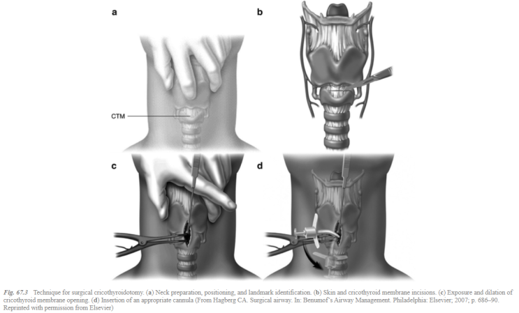 Cricothyroidotomy (윤상갑상절개술) Part Ⅰ : 네이버 블로그