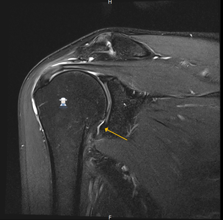 오십견 frozen shoulder의 진단 axillary recess thickness CHL 초음파검사 : 네이버 블로그