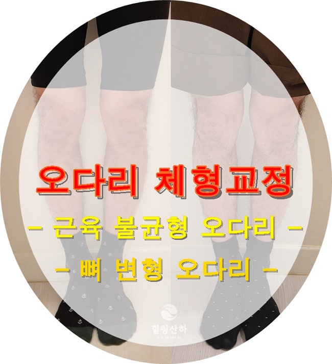 전주 체형교정 오다리 원인부터 해결 하자 네이버 블로그