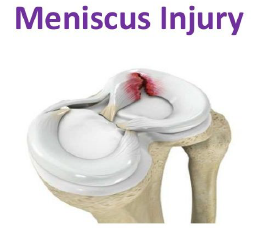 [원내 컨퍼런스] 침구과 - Flap tear of post. horn of Lateral Meniscus : 네이버 블로그