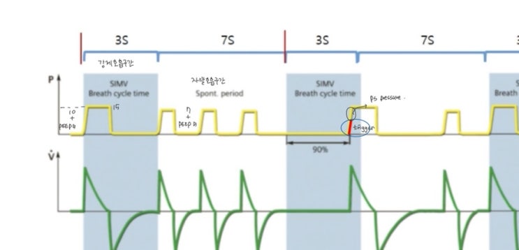 SIMV 모드 이해 : 네이버 블로그