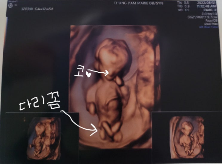 임신기록 12 임신 12주차 기록 청담마리산부인과 1차 기형아 검사 입체 초음파 정말 초음파 각도법 네이버 블로그