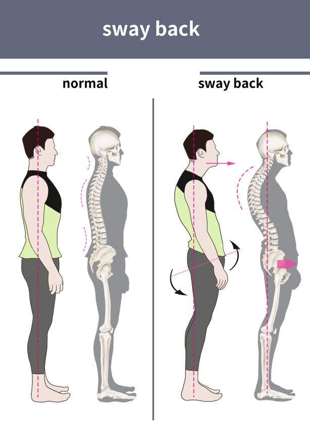 [나성동필라테스]sway back에 좋은 동작 알아볼게요! : 네이버 블로그