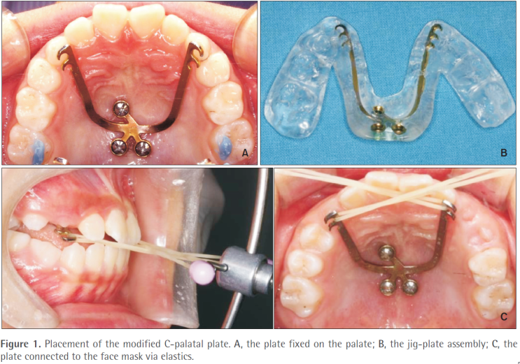 [논문] New approach of maxillary protraction using modified C-palatal ...