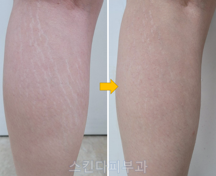 미라젯 튼살 레이저 총정리치료원리가격후기효과높이는 명심할점4가지 네이버 블로그