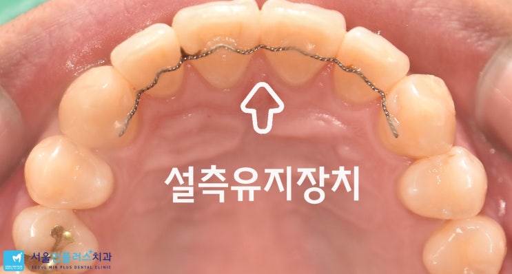 강북구 치아교정 으로 틀어진 어금니를 개선했습니다. : 네이버 블로그