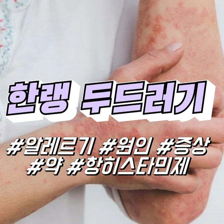 한랭 두드러기 알레르기 증상 벌써 25년째 원인 진단 항히스타민제 네이버 블로그
