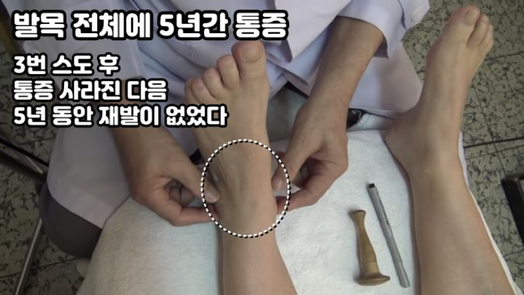 111. 발목 관절 퇴행성 통증, KSNS KSS 스본 스도 공부 자료 : 네이버 블로그