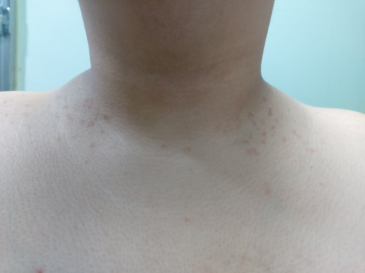 색소성양진(키토래쉬/keto rash) 관리 후기 (feat 피부과 전문의 진료) : 네이버 블로그