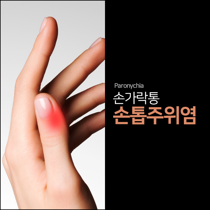 손톱주위염 생인손 조갑주위염 손톱염증 손톱고름 손가락통증 서울정형외과 내과 종합검진센터 네이버 블로그