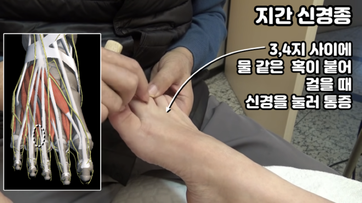 112. 지간 신경종, KSNS KSS 스본 스도 공부 자료 : 네이버 블로그