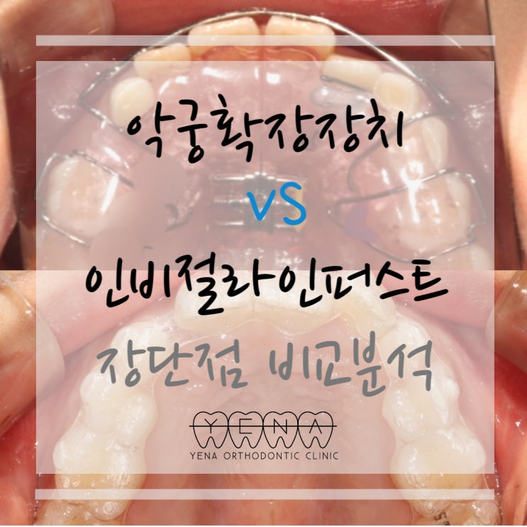 1차교정 악궁확장장치 Vs 인비절라인퍼스트 장단점 비교 치료후기ㅣ동탄소아교정전문 네이버 블로그