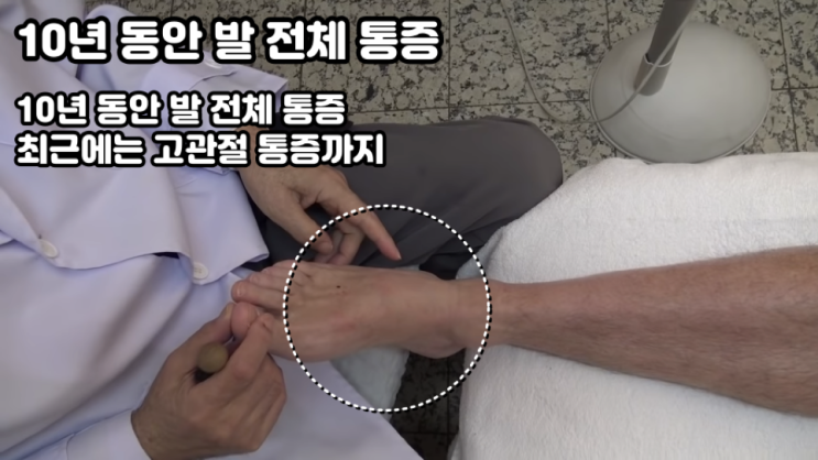 113. 발바닥, 발목 관절, 발 전체 통증 10년, 4번 스본 스도 후 없어져 KSNS KSS 공부 자료 : 네이버 블로그