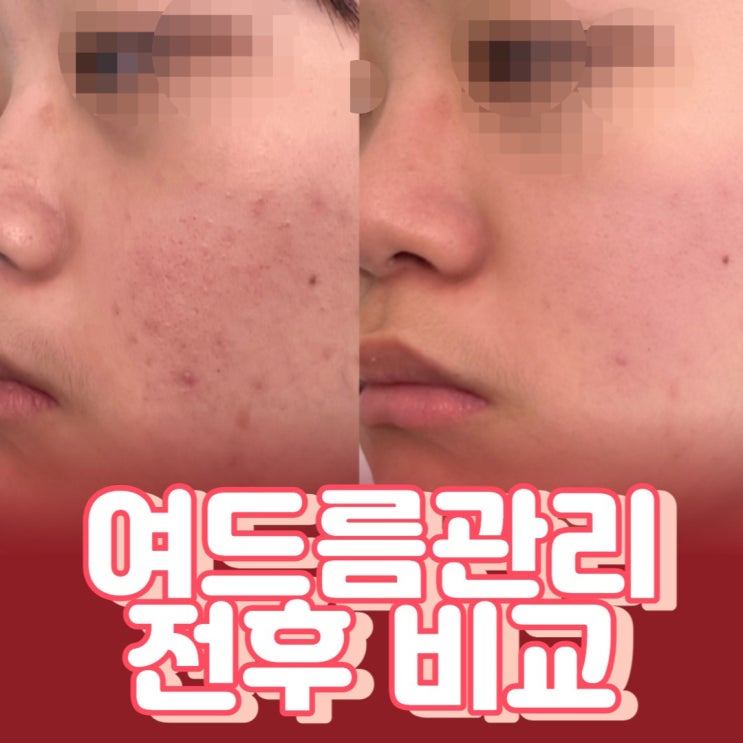 피부과 관리만큼 확실한 일산피부관리실 주엽동 여드름 관리 전후 사진 올려요 네이버 블로그