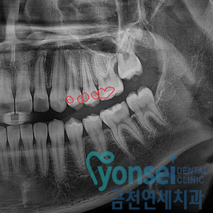 동남지구 치과 금천연세치과 육안으로 알기 힘든 치아 사이에 생긴 다수의 충치가 생긴 경우 네이버 블로그
