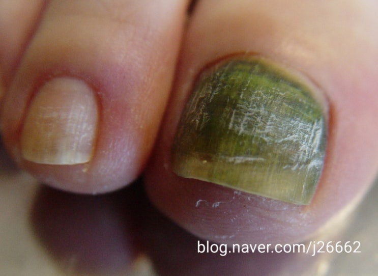 7. 녹색손발톱(Green nail syndrome / Chloronychia : 네이버 블로그