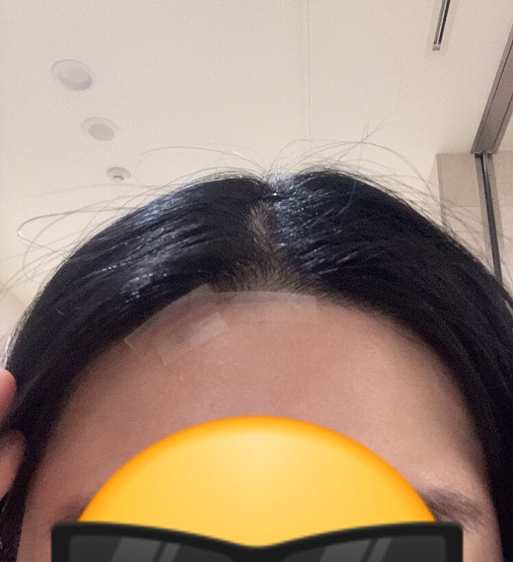좁은 이마and3자 이마의 헤어라인 레이저 제모 3차 후기 이것은 부작용인가 흉터가 생기다 네이버 블로그