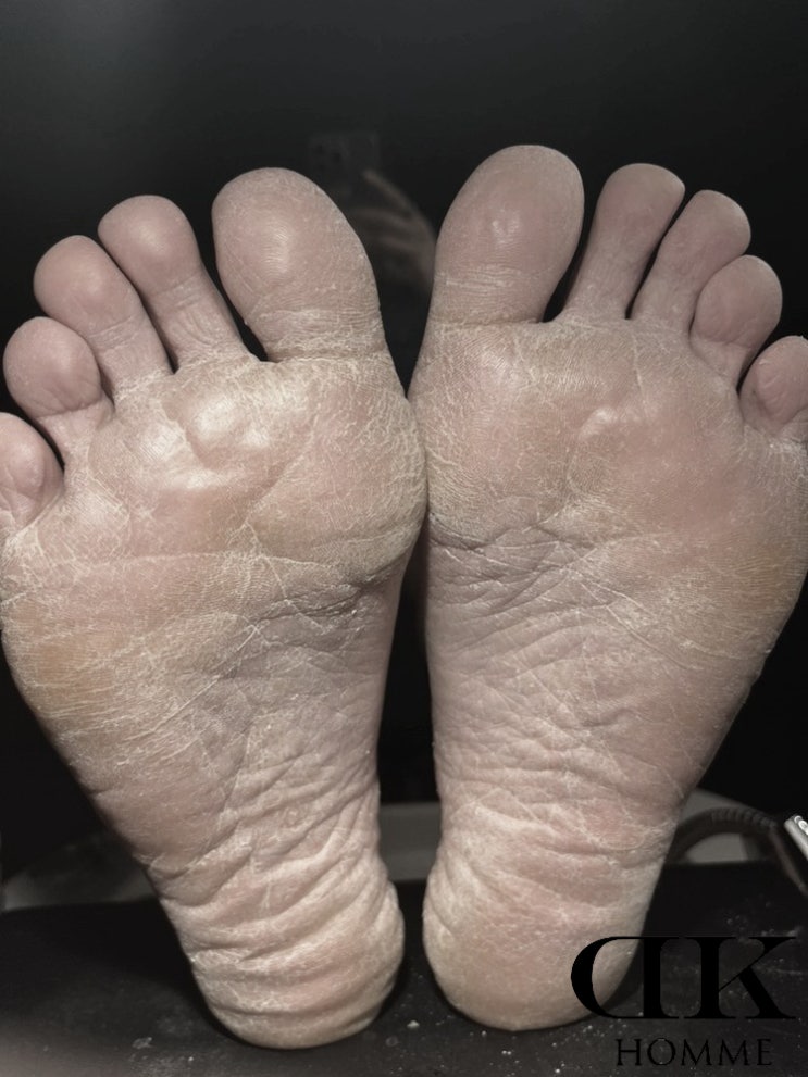 남자 발바닥 굳은살과 발뒤꿈치가 갈라져 고민 된다면강남 남성전용 프라이빗 발각질제거샵feat디케이옴므 네이버 블로그