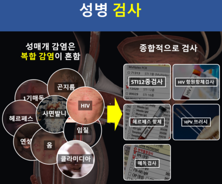 성병검사 기록에 안 남게 받는 방법 익명 성병검사 매독 에이즈 임질 곤지름 헤르페스 네이버 블로그