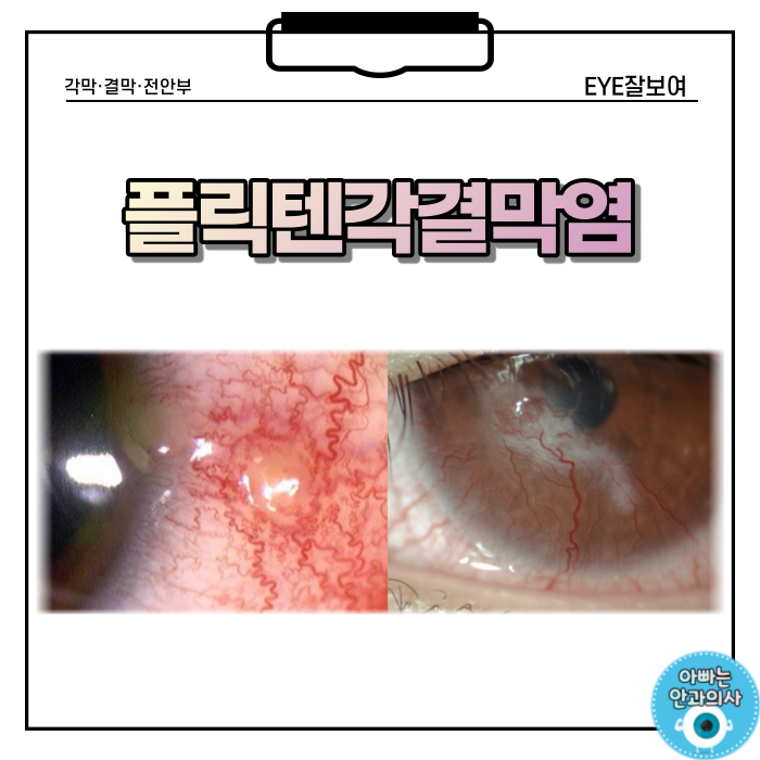 오래가는 충혈, 낫지 않는 결막염일 때는 '플릭텐각결막염(Phlyctenulosis), 플릭텐(Phlycten)'을 의심해보자 ...