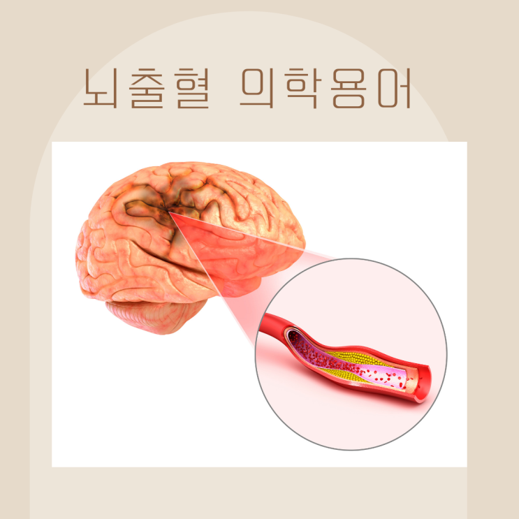 의학용어 ICH IVH EDH SDH SAH 뇌출혈 부위에 따라 : 네이버 블로그