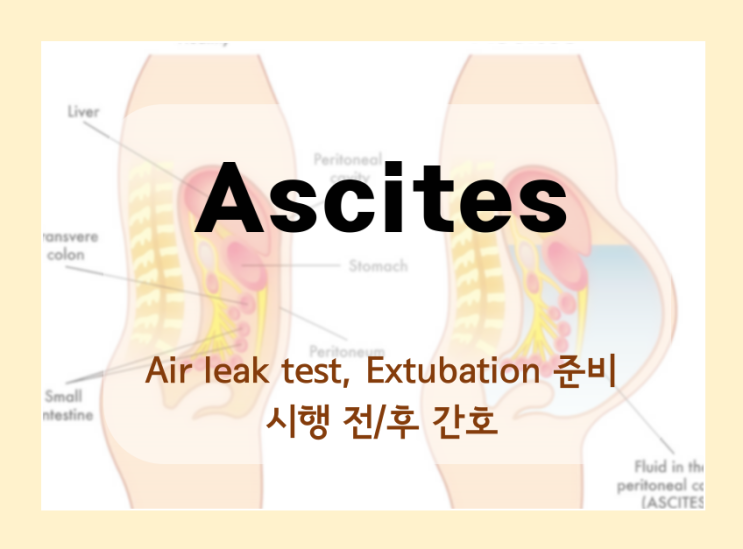 Ascites 복수 : 원인/진단/치료,간호 (Paracentesis) : 네이버 블로그