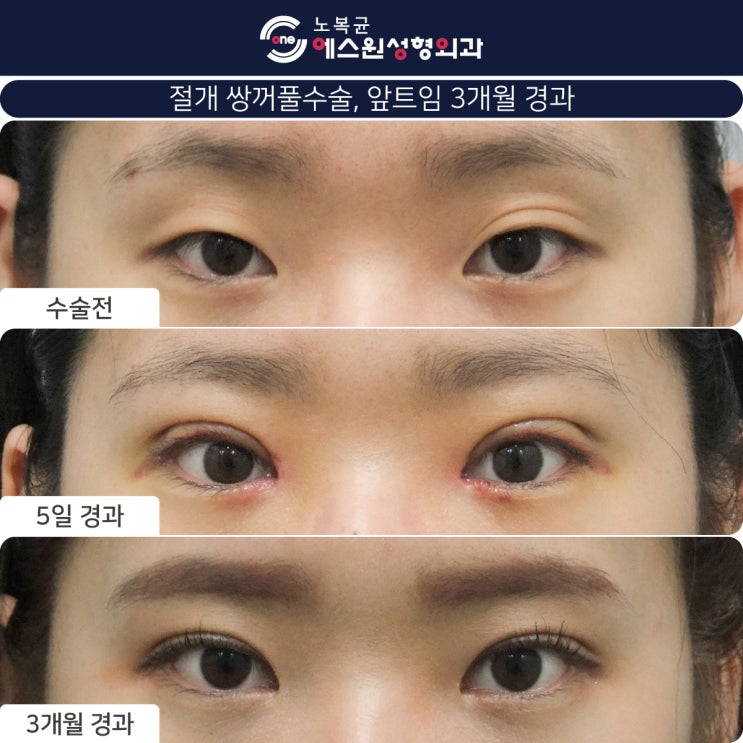 압구정 성형외과 쌍꺼풀 수술 전후 및 방법 비교 : 네이버 블로그