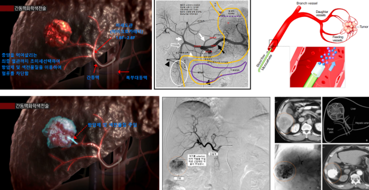 간종양(간세포암,HCC)에 시행하는 경동맥화학색전술(TACE) 알아보기(간암화학색전술/간동맥화학색전술) : 네이버 블로그