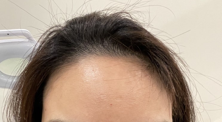 용산왁싱잘하는곳 이마 헤어라인 잔머리 해결 승무원 헤어라인왁싱 네이버 블로그