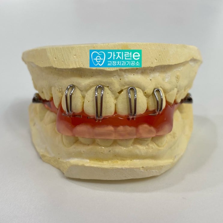 토이셔장치(Teuscher) : 네이버 블로그