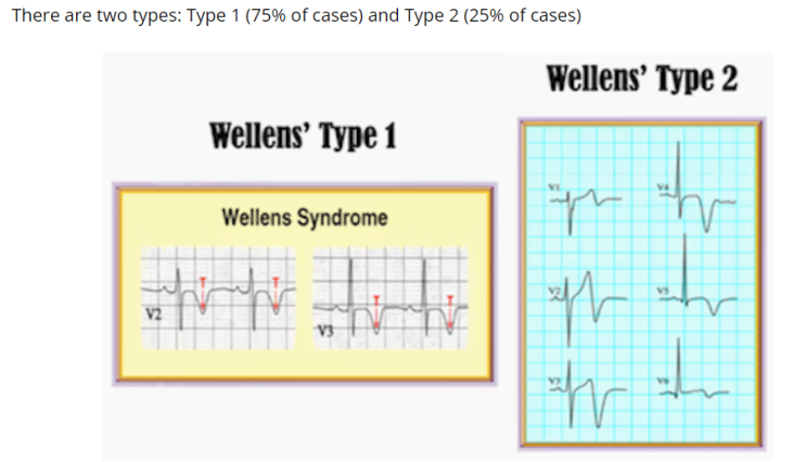 ECG(심전도) - Wellens syndrome (Wellens 증후군) : 네이버 블로그