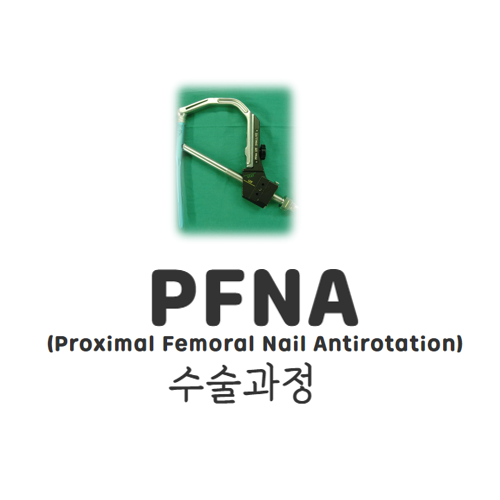 PFNA (Proximal Femoral Nail Antirotation) 수술 과정 : 네이버 블로그