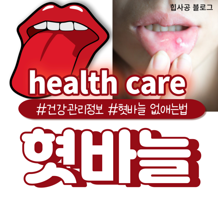 혓바늘 없애는법 및 원인 약 알보칠 치료법 네이버 블로그