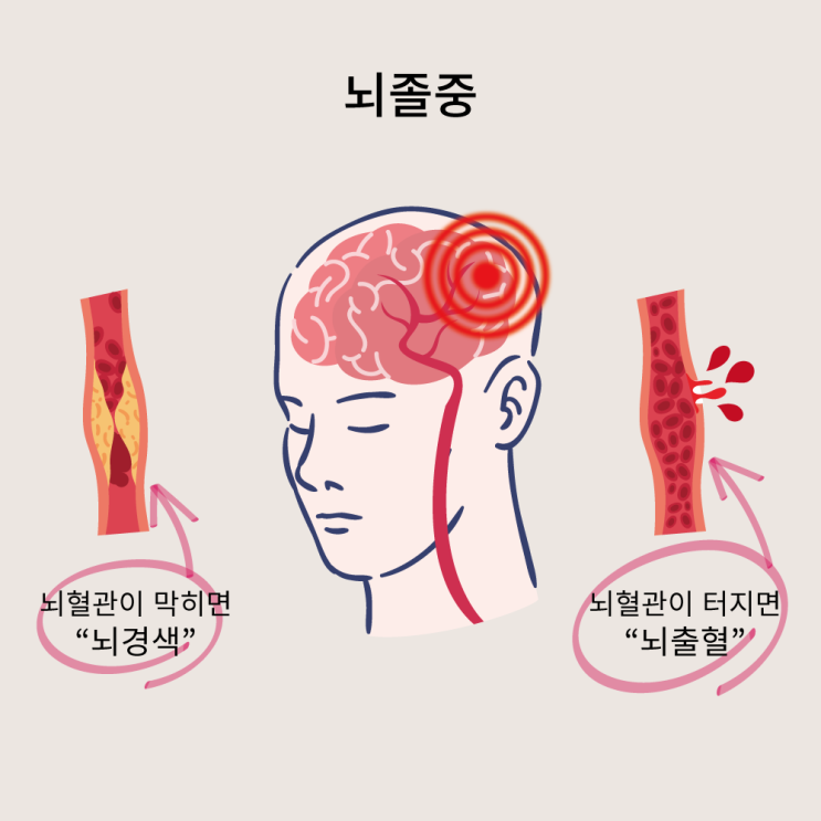 뇌 Mra 검사 🧠 뇌경색 뇌줄중 조기 검사 방법 경동맥초음파 네이버 블로그