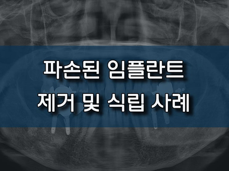 호원동 진플란트치과 파손된 임플란트 제거 및 식립 사례 네이버 블로그