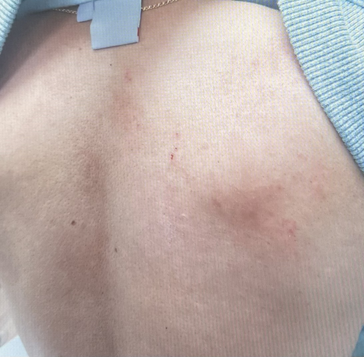 여름맞이 피부관리 등드름 미스트 추천사용 후기 네이버 블로그