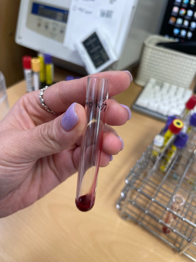 Direct coombs' Test 직접항글로불린 검사 : 네이버 블로그