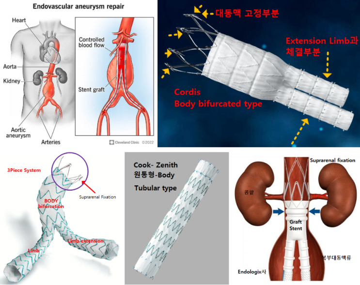복부대동맥류(AAA, abdominal aortic aneurysm)에 대한 중재적 치료(EVAR)의 접근 : 네이버 블로그