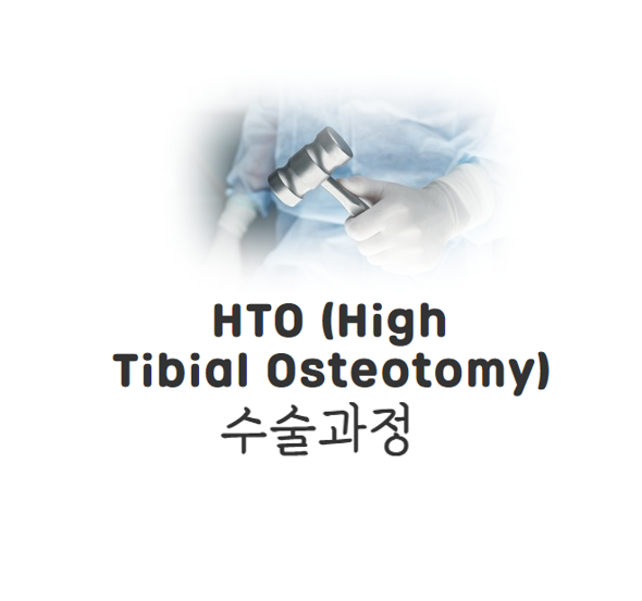 HTO (High Tibial Osteotomy), Open Wedge Osteotomy수술과정 : 네이버 블로그