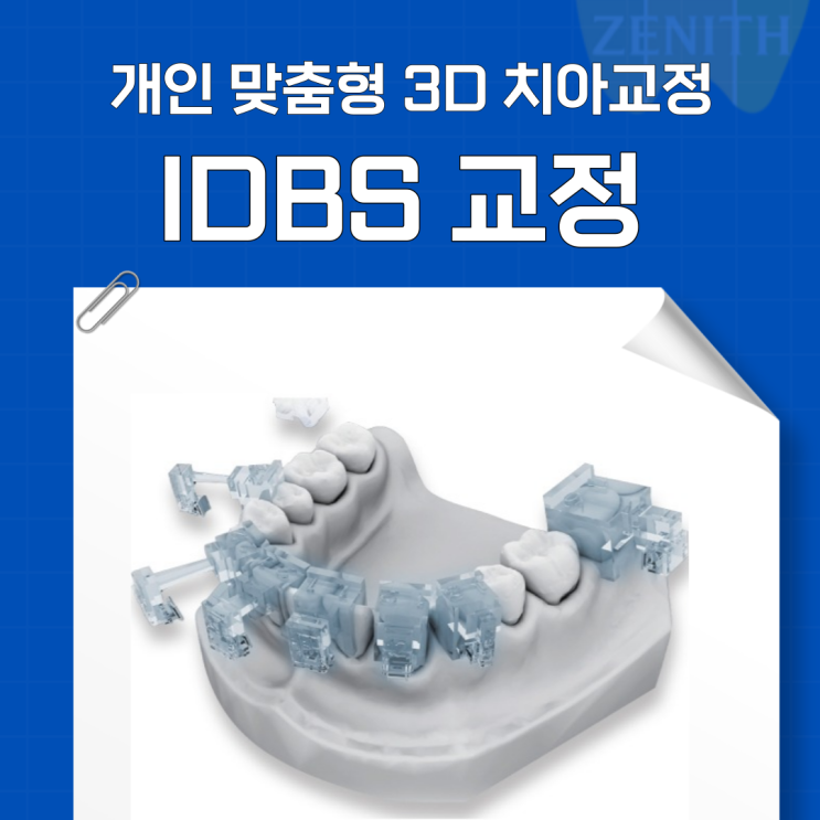 개인 맞춤형 3D 치아교정, IDBS 교정 : 네이버 블로그