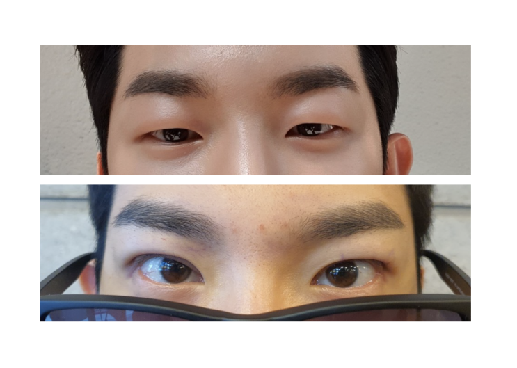 남자 절개 눈매교정 쌍수 후기 쌍수 전 ~ 3일차 네이버 블로그