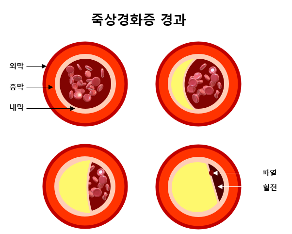 죽상경화증atherosclerosis 정의와 합병증관리 방법 네이버 블로그