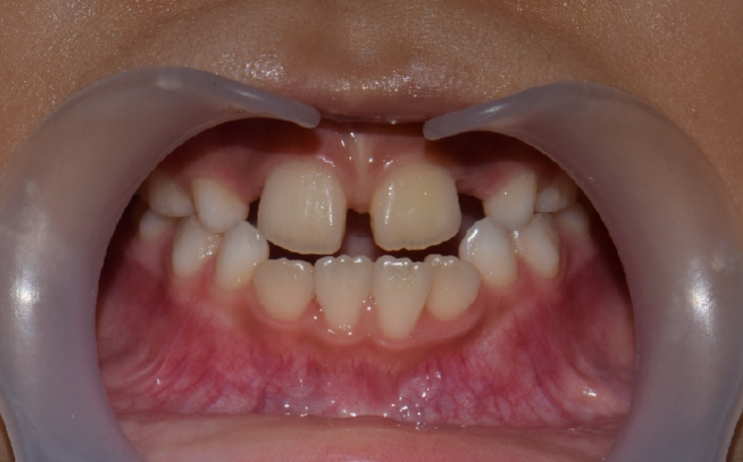 [힐치과] 소아교정,턱교정,주걱턱교정,프랑켈(Frankel)교정장치 : 네이버 블로그