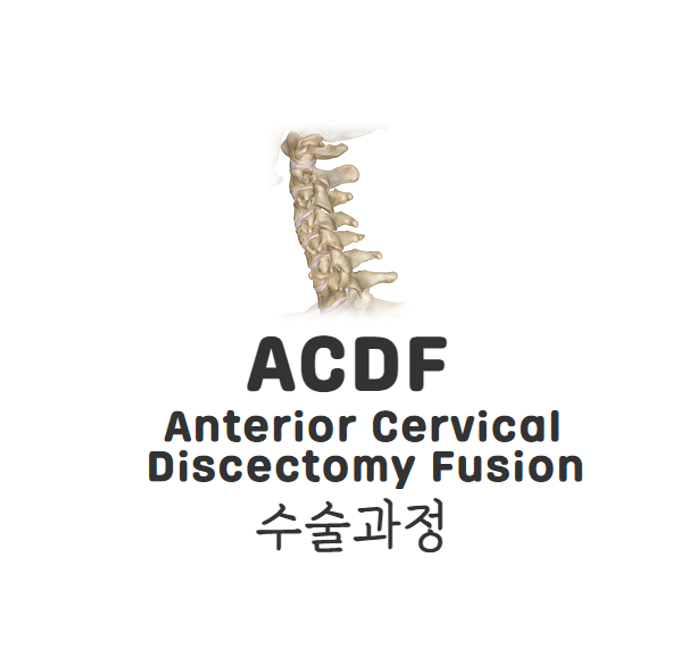 ACDF (전방 경추 추간판 절제 유합술) 수술 과정 / 수술 프로시저 : 네이버 블로그