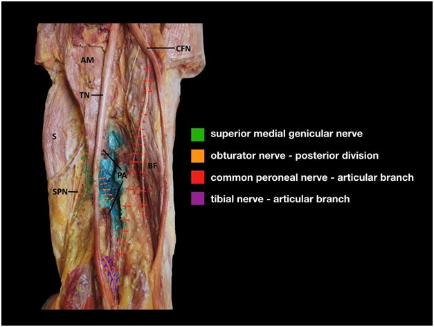 genicular nerve block, iPACK block : 네이버 블로그