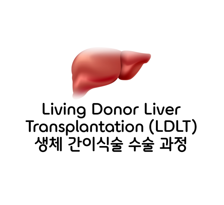 Living Donor Liver Transplantation (LDLT) 생체 간이식술 수술 과정 : 네이버 블로그