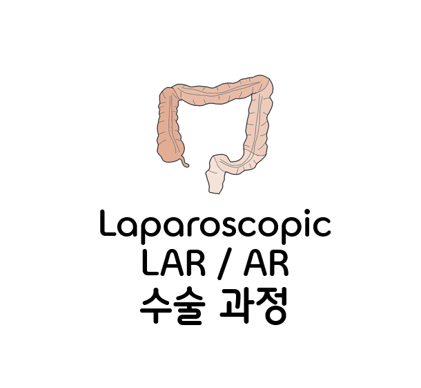 Laparoscopic Low Anterior Resection, Anterior Resection (LAR, AR) 수술과정 ...